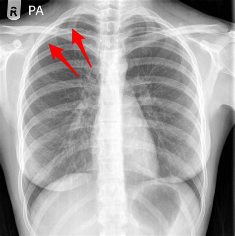 Apical Pneumothorax X Ray Heres My Cxr From Earlier This Year