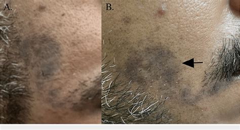 Figure 1 From Unilateral Linear Lichen Planus Pigmentosus Responding To