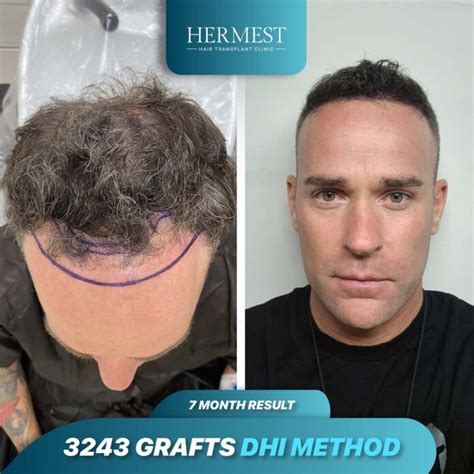 10 Best Hair Transplant Clinics In Turkey For International Patients