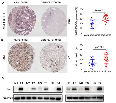 Expression Correlation Analysis Of Lncrna Mrps30 Dt And Jab1 In Breast