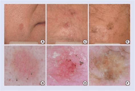 Skin Cancer Actinic Keratosis Pictures