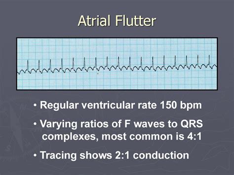 Basics Of Ekg Interpretation Online Presentation