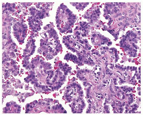 Glomus Tumor Basicmedical Key