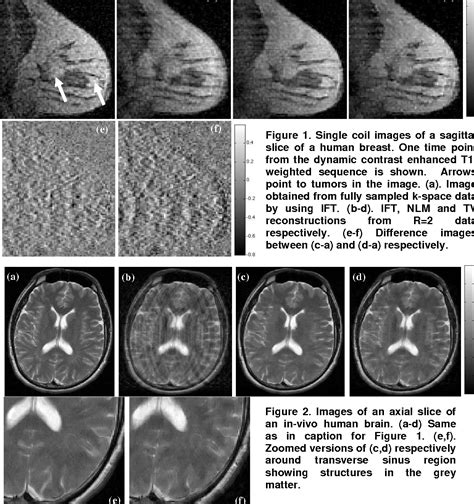 Figure 2 From Improving Undersampled Mri Reconstruction Using Non Local Means Semantic Scholar