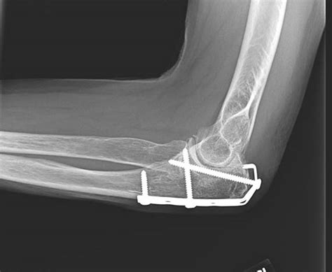 Coronoid Process Of Ulna Fracture