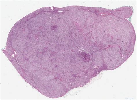 Diffuse Nodular Adrenocortical Hyperplasia Atlas Of Pathology