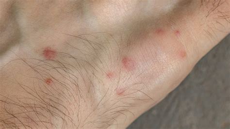 What Bed Bug Rashes Look Like Bed Bug Bites Vs Other Insect Bites