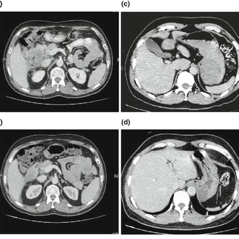 A Axial Computed Tomography Ct Of A Duodenal Gastrointestinal Stromal
