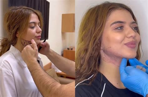 Մարինկա Խաչատրյանը դիմել է արտաքին վիրահատական միջամտության լուսանկարներ Showbiz Am