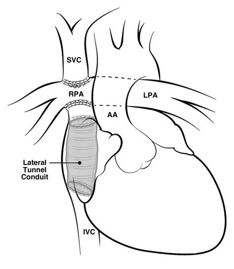 Fontan Procedure Uses Types Recovery And Complications