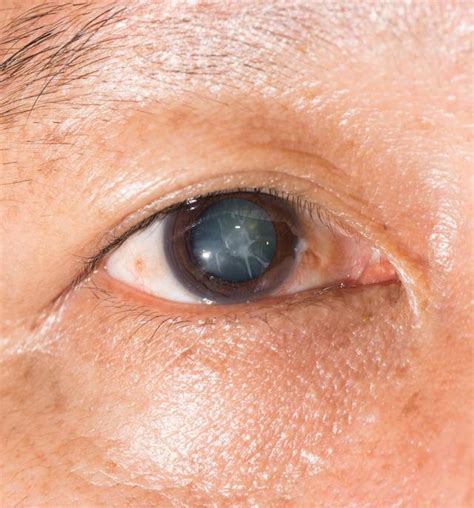 吸菸和吸二手菸都有可能致失明千萬不要給煙燻到眼睛 每日頭條