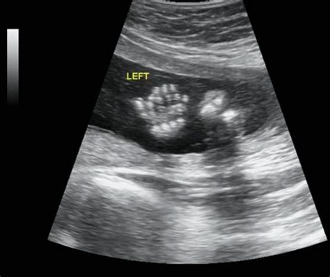 Sumera Sadiq On Linkedin Non Invasive Prenatal Test For Trisomy It Is Definitely Possible That