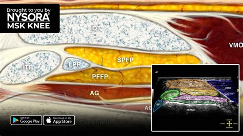 Quadriceps Tendon Ultrasound Quadriceps Tendonitis Treatment
