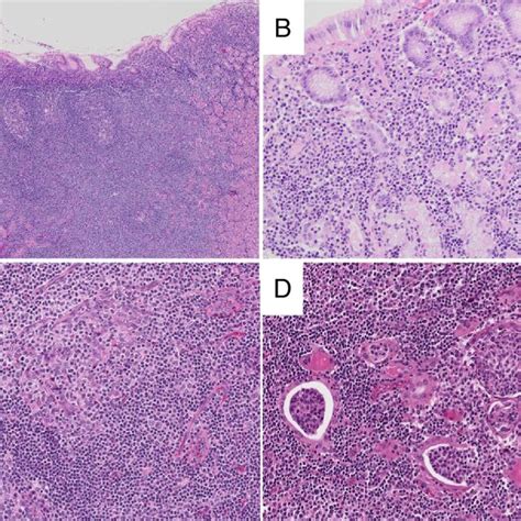 Extranodal Marginal Zone Lymphoma In Gastric Malt Lymphoma The Mucosa