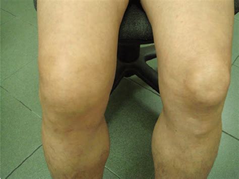 Warm Right Knee Effusion Caused By Synovitis In Knee Oa Download