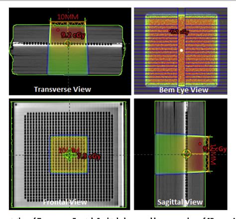 Figure 4 From Validation Of Dosimetric Leaf Gap Dlg Prior To Its