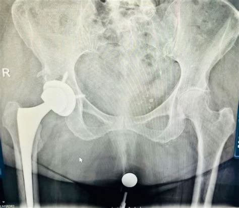 Watson Extraction System On Linkedin Jointreplacement Arthroplasty Orthopedics Orthopaedics