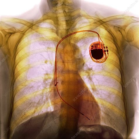 Dual Chamber Pacemaker X Ray Stock Image F008 3508 Science Photo