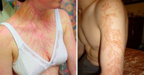 Lichtenberg Figure Scars On People Who Have Been Hit By Lightening