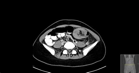 Axial Section Of Abdominal Ct Revealing Target Sign Of Ileocolic Download Scientific Diagram