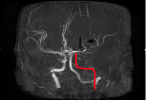 Mra Showing Smaller Left M2 Branches Arrowhead The Left Mca Is Also Download Scientific