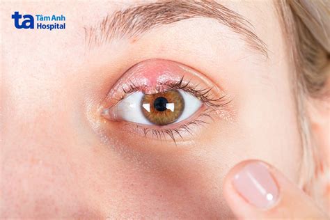 11 Cách Chữa Lẹo Mắt An Toàn Hiệu Quả Và điều Trị Tại Nhà