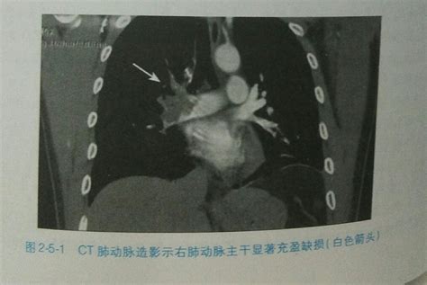 引起呼吸困难的病历。