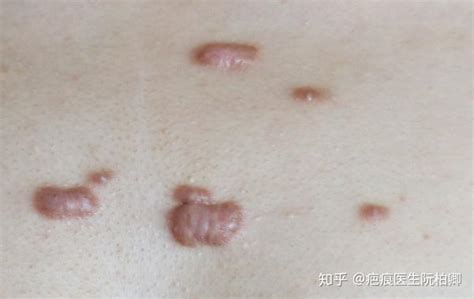 疤痕疙瘩是如何形成的 知乎