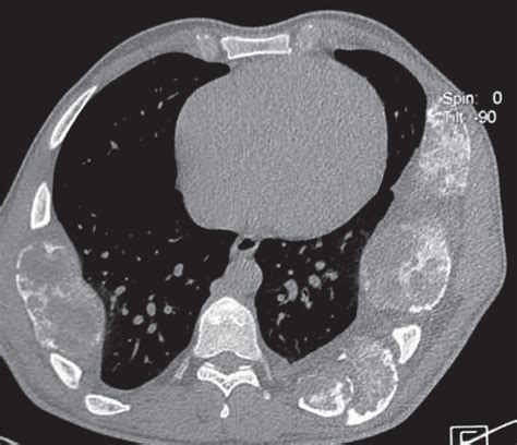 Dysplasie Fibreuse Polyostotique à Propos Dun Cas Historique Figure 5