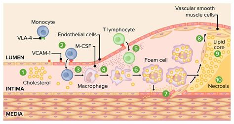 Atherosclerosis Concise Medical Knowledge