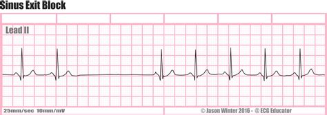 Ecg Educator Blog Sinus Exit Block