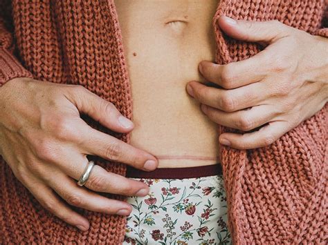 Incisional Hernia Symptoms Causes Risk Factors And Treatment