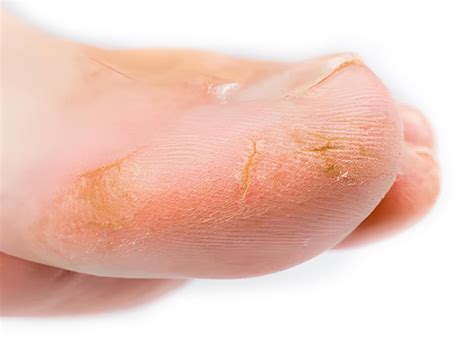 Если трескается кожа на пальцах ног Stopa