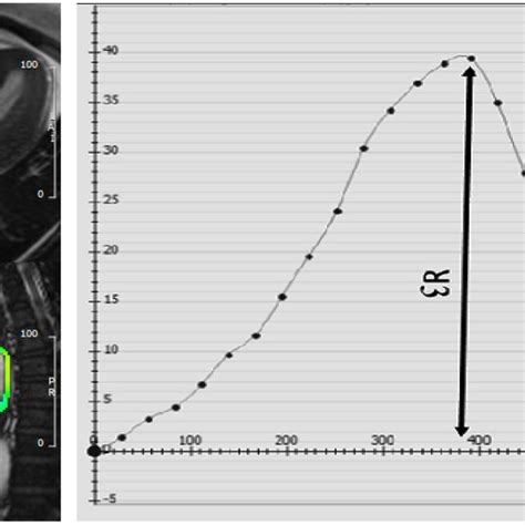 Left Atrial Strain Measurement Using Cardiac Mri Feature Tracking A Download Scientific