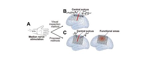Automated Intraoperative Central Sulcus Localization And Somatotopic Mapping Using Median Nerve