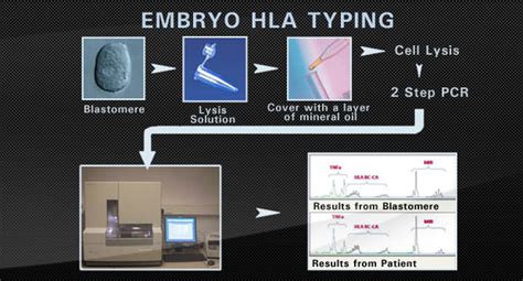 Embryo Hla Typing Jinepol Ivf Center Turkey