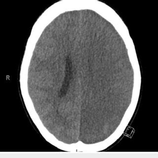 CT Scan Of The Brain Showing Diffuse Cerebral Edema With Effacement Of Download Scientific