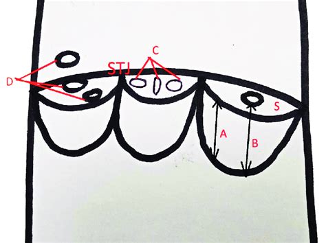 A And B Distance Of Upper Margin Of Aortic Cusp And Ostium From