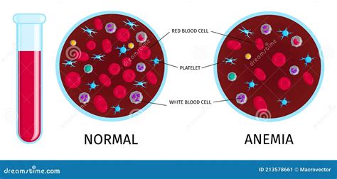 Blood Cells Anemia Chart Stock Vector Illustration Of Analysis