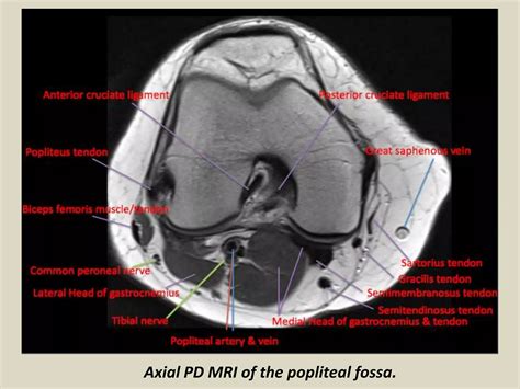 Presentation1 Radiological Imaging Of Popliteal Fossa Masses Pptx