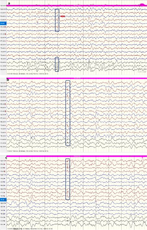 Interictal Video EEG A Sharp Waves Distributed In The Left Temporal Download Scientific