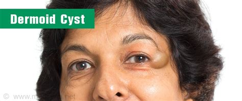 Dermoid Cyst Causes Symptoms Diagnosis Treatment And Prevention