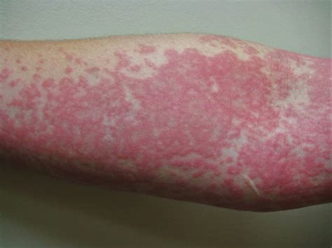 How To Treat Skin Rashes At Edyth Herndon Blog