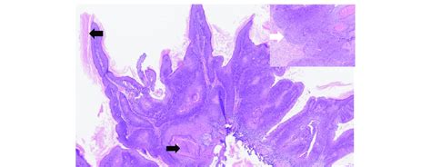 Material Sampled By Transurethral Resection Of Bladder Tumour Shows An Download Scientific