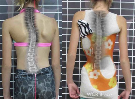 Rigo Cheneau Scoliosis Orthosis Del Bianco Prosthetics And Orthotics