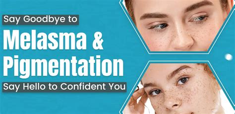 Melasma Reduction In Delhi Best Pigmentation Treatment In Delhi