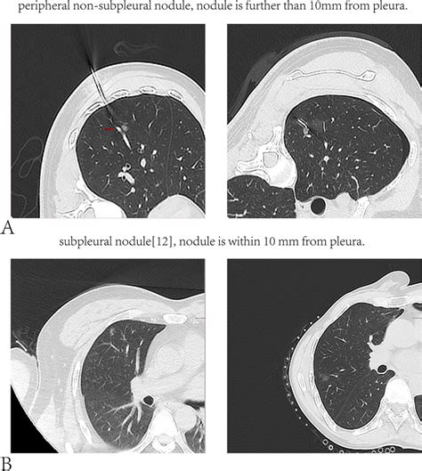Peripheral Pulmonary Nodules Can Be Divided Into Two Types According To Download Scientific