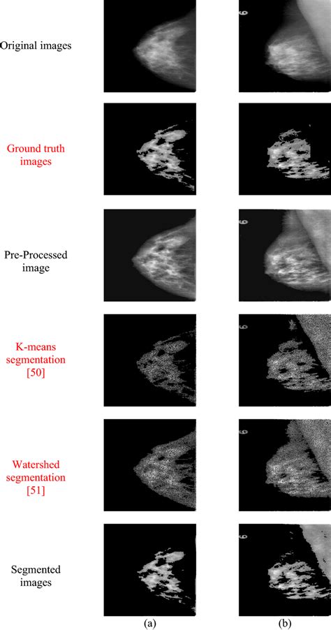 Original And Segmented Mammogram Images A Benign And B Malignant Download Scientific Diagram