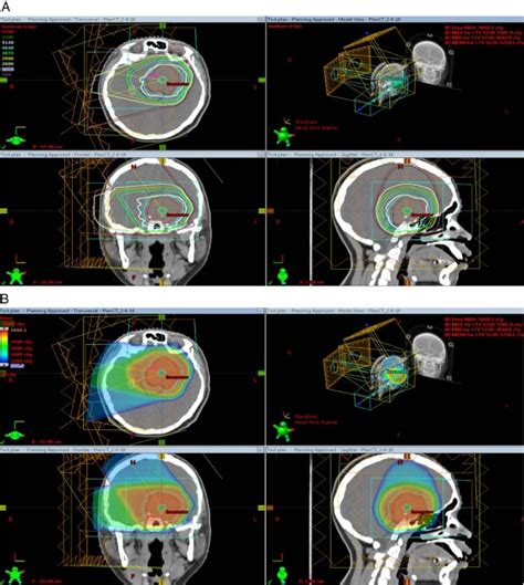 3d Treatment Planning System—varian Eclipse For Proton Therapy Planning