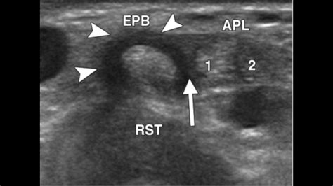 Ultrasound Guided Musculoskeletal Injections Internet Book Of Msk